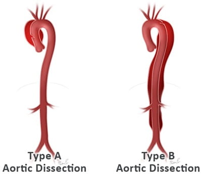 Aortic Dissection | Main Line Health