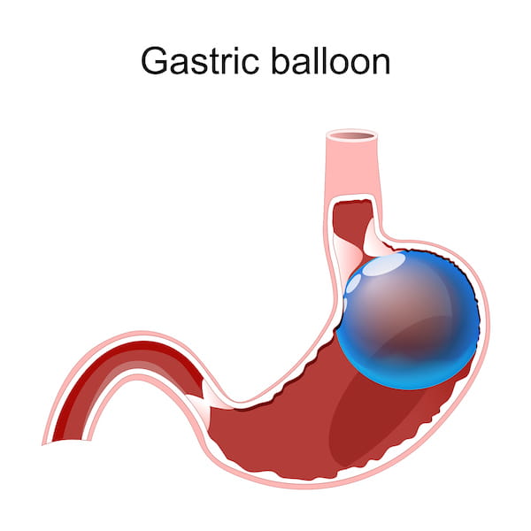 Intragastric Balloon Surgery | Main Line Health
