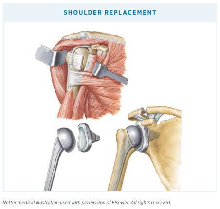 Preparing for Shoulder Surgery | Your Guide to Shoulder Surgery | Main ...
